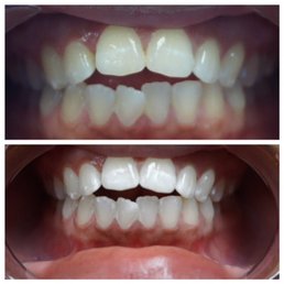 Pure White Teeth Whitening - Teeth Whitening - Fourth Ward, Houston, TX ...